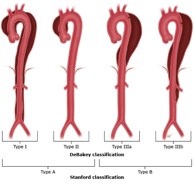 Disección Aórtica: Una verdadera emergencia cardiovascular