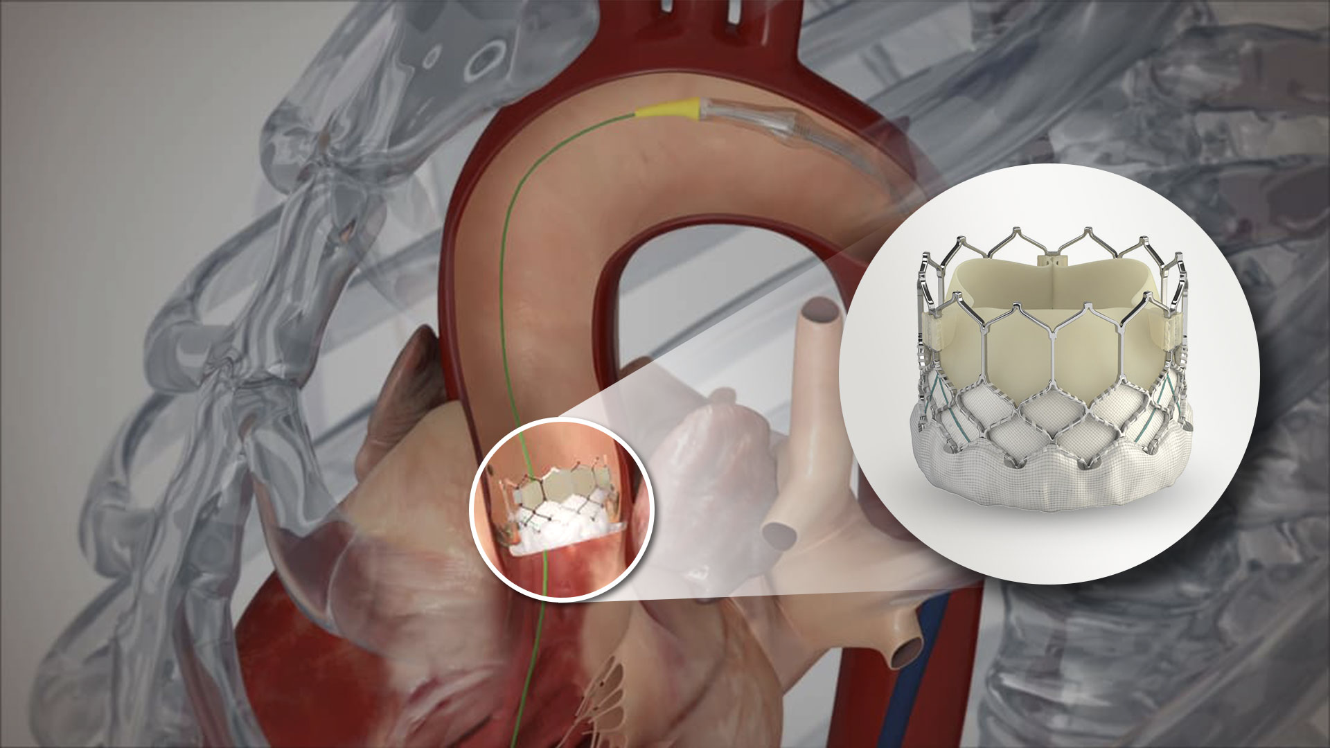 11 preguntas rápidas relacionadas con TAVI